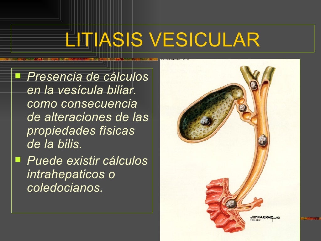 Litiasis vesicular