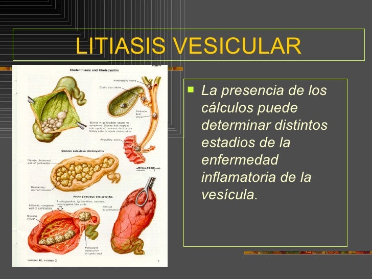 Litiasis vesicular