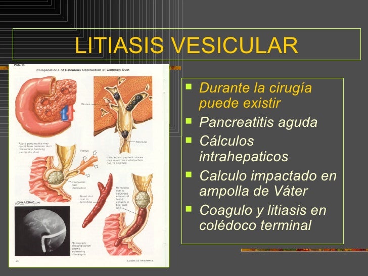 Litiasis vesicular