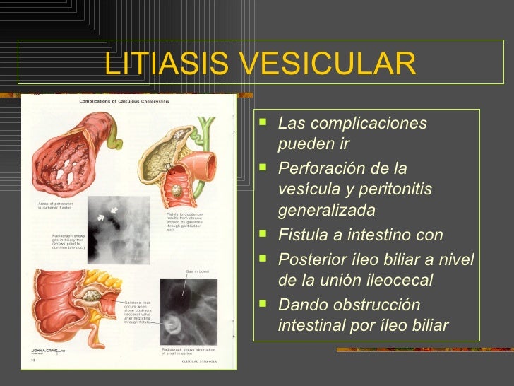Litiasis vesicular