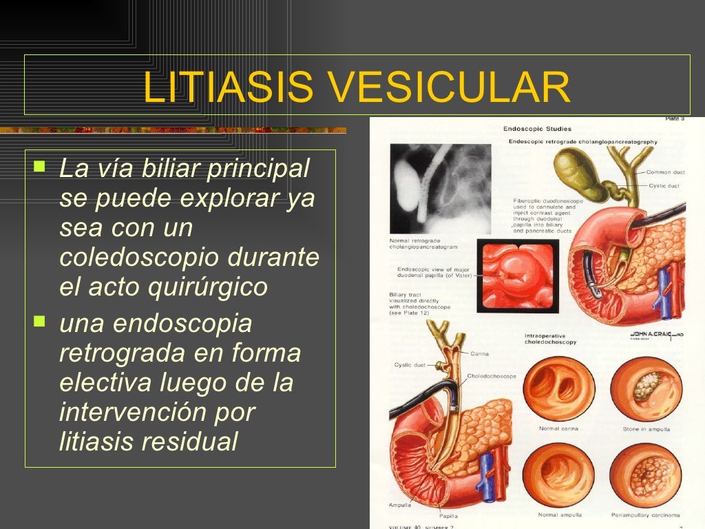 Litiasis vesicular