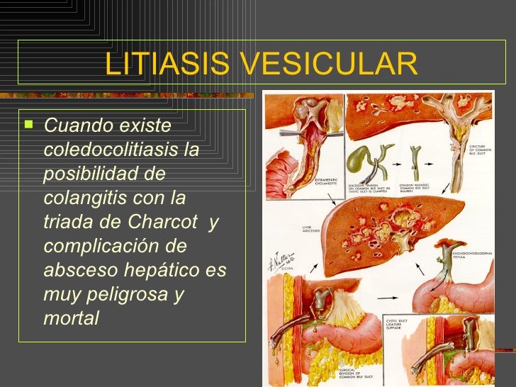 Litiasis vesicular