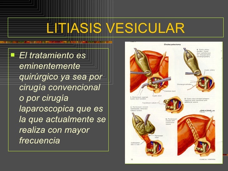 Litiasis vesicular