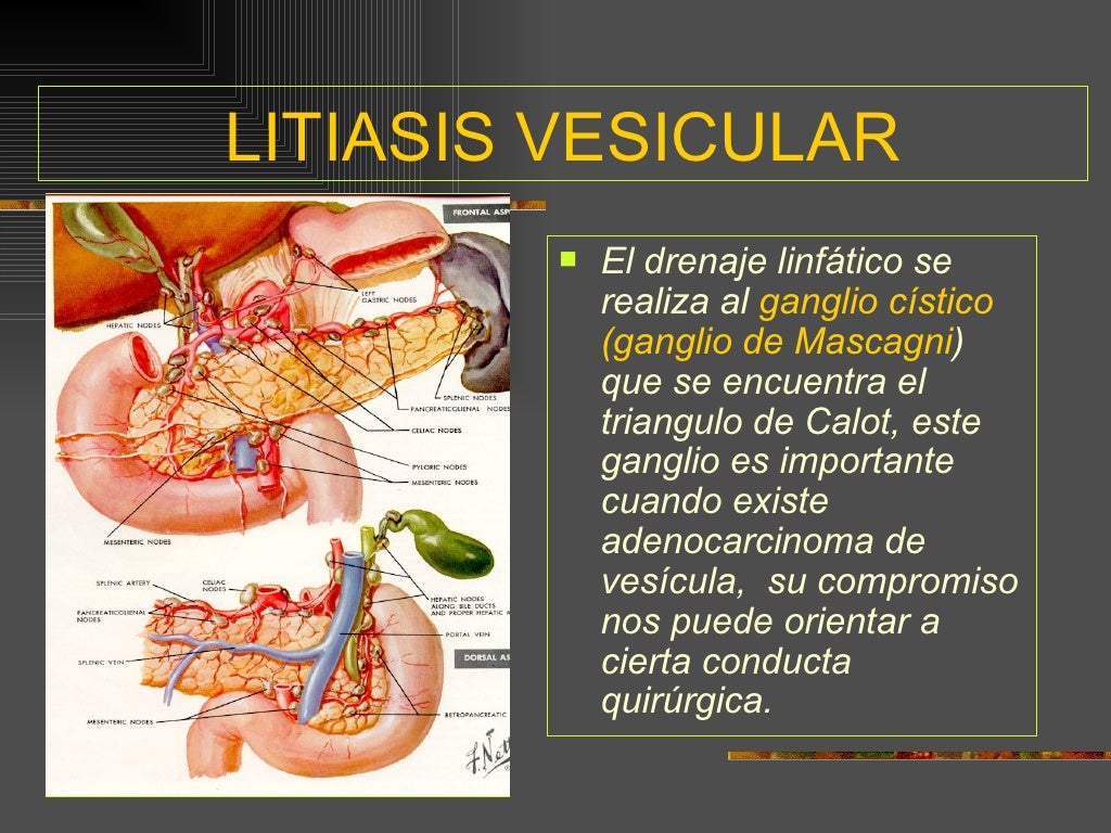 Litiasis vesicular