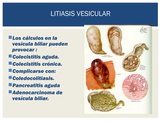 Litiasis vesicular | PPT