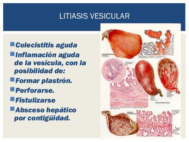 Litiasis vesicular