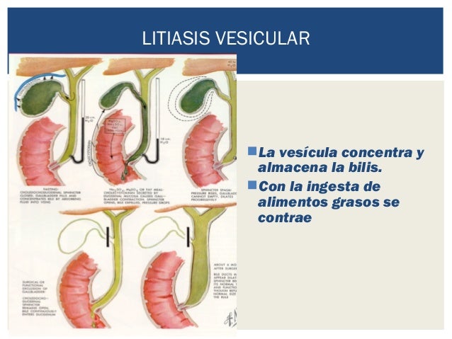 Litiasis vesicular