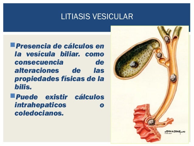 Litiasis vesicular
