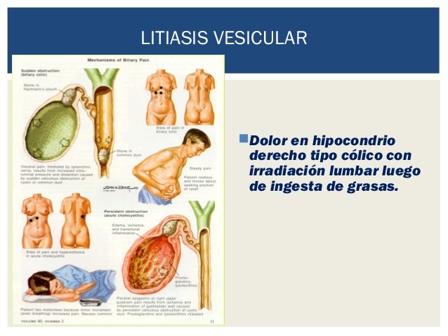 Litiasis vesicular