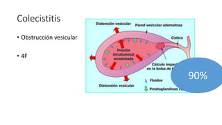 Litiasis vesicular | PPTX