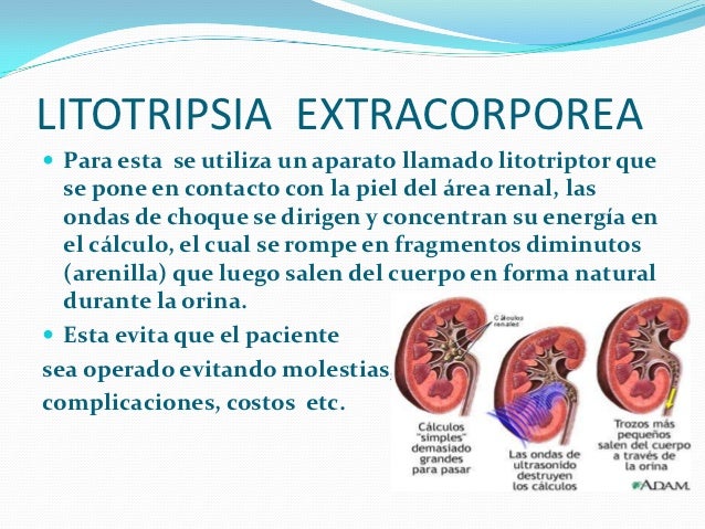 Maquina De Litotripsia