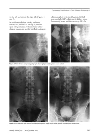 Litotrissia percutanea laparoscopica nel rene pelvico casi clinici ...