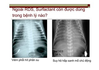 Liệu pháp surfactant trong điều trị suy hô hấp sơ sinh | PDF