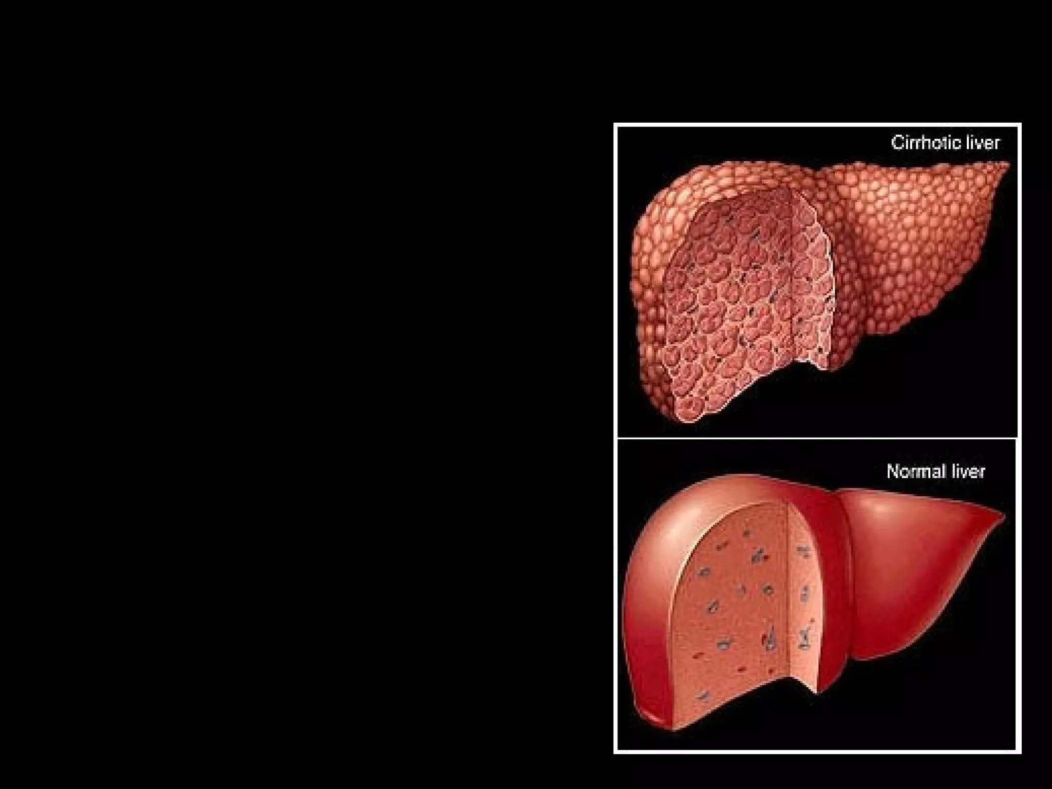 Pathophysiology of liver | PPT