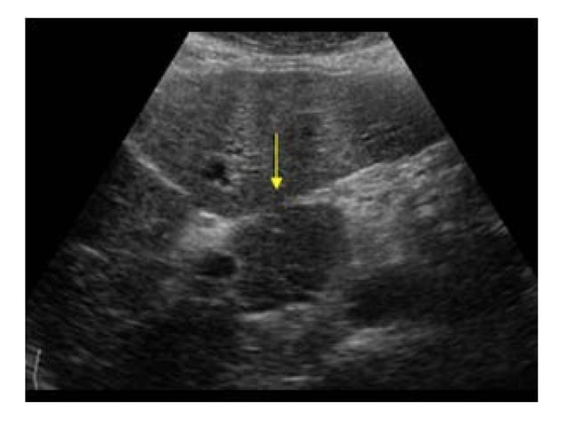 Diagnostic Imaging of the Liver | PPT