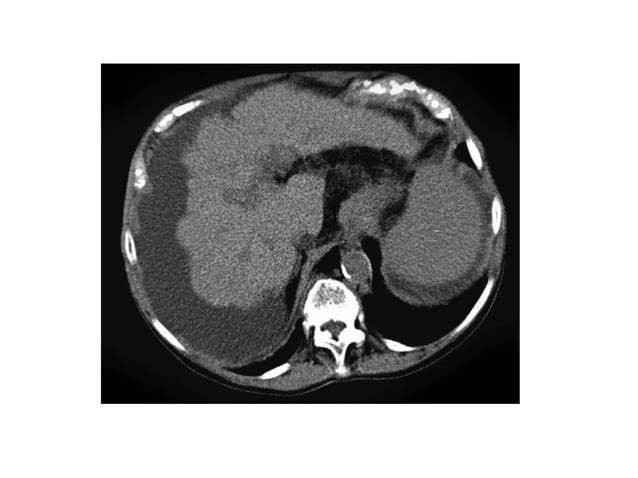 Diagnostic Imaging of the Liver | PPT