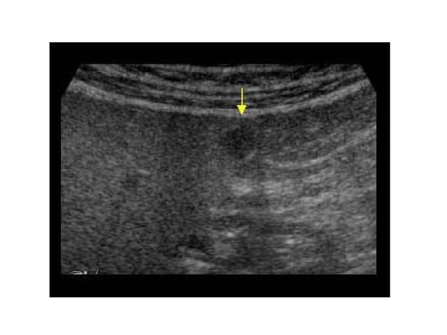 Diagnostic Imaging of the Liver | PPT