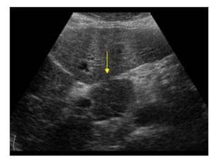 Caudate Lobe Of Liver Ultrasound