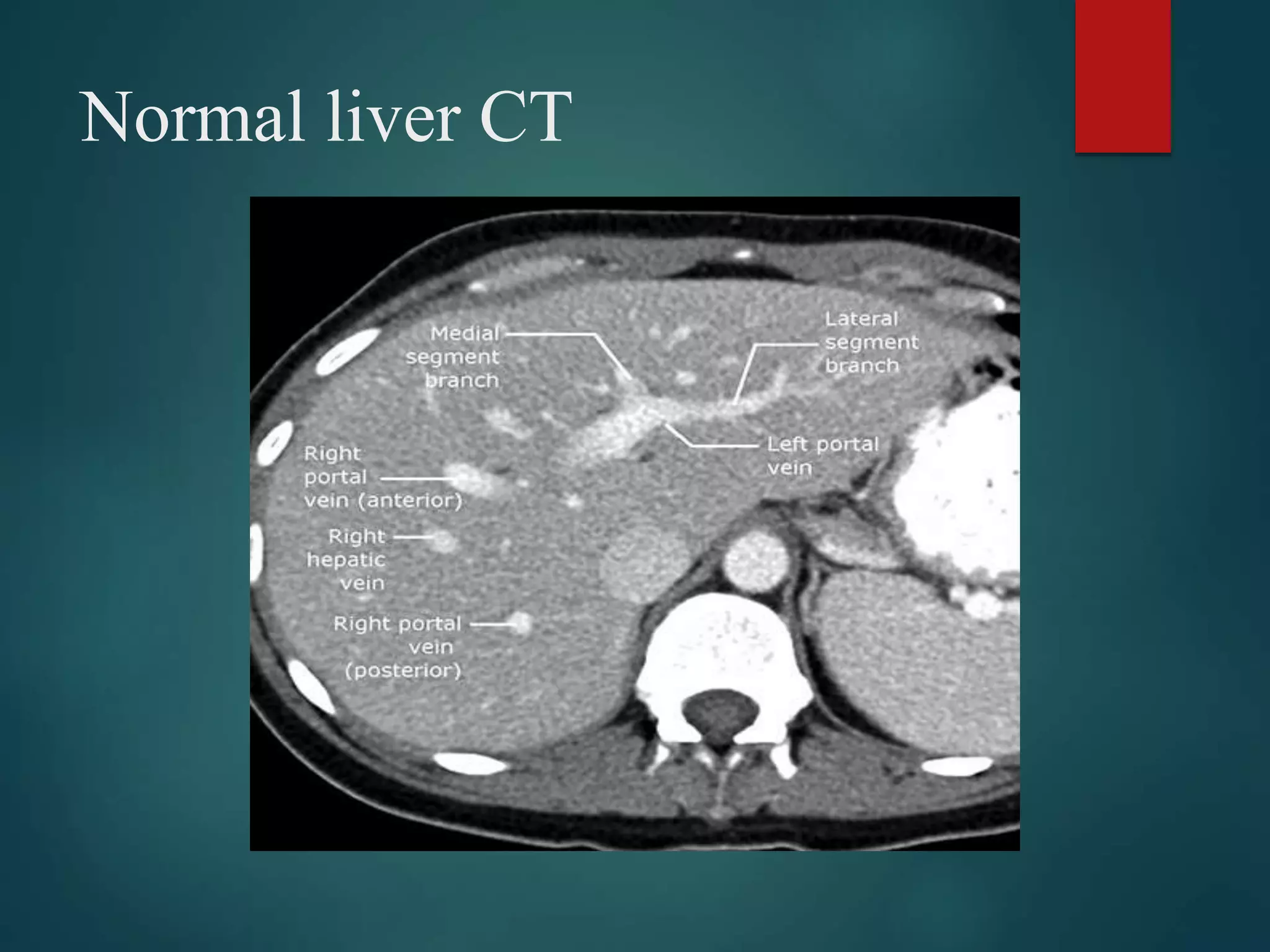 Abdomin Liver CT | PPTX