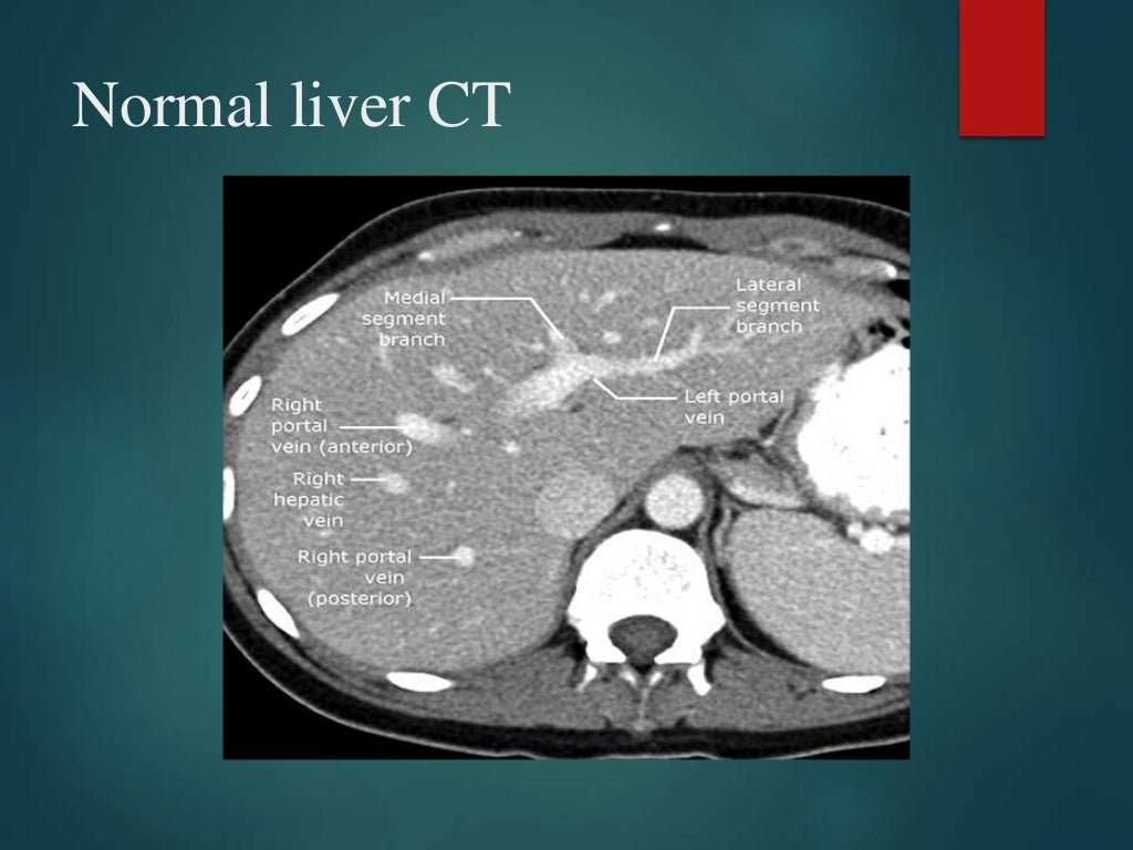 Abdomin Liver CT