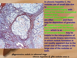Recent Advances:Hepatocellular Nodules | PPT