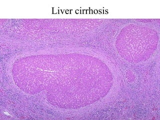 LIVER PATHOLOGY | PPT
