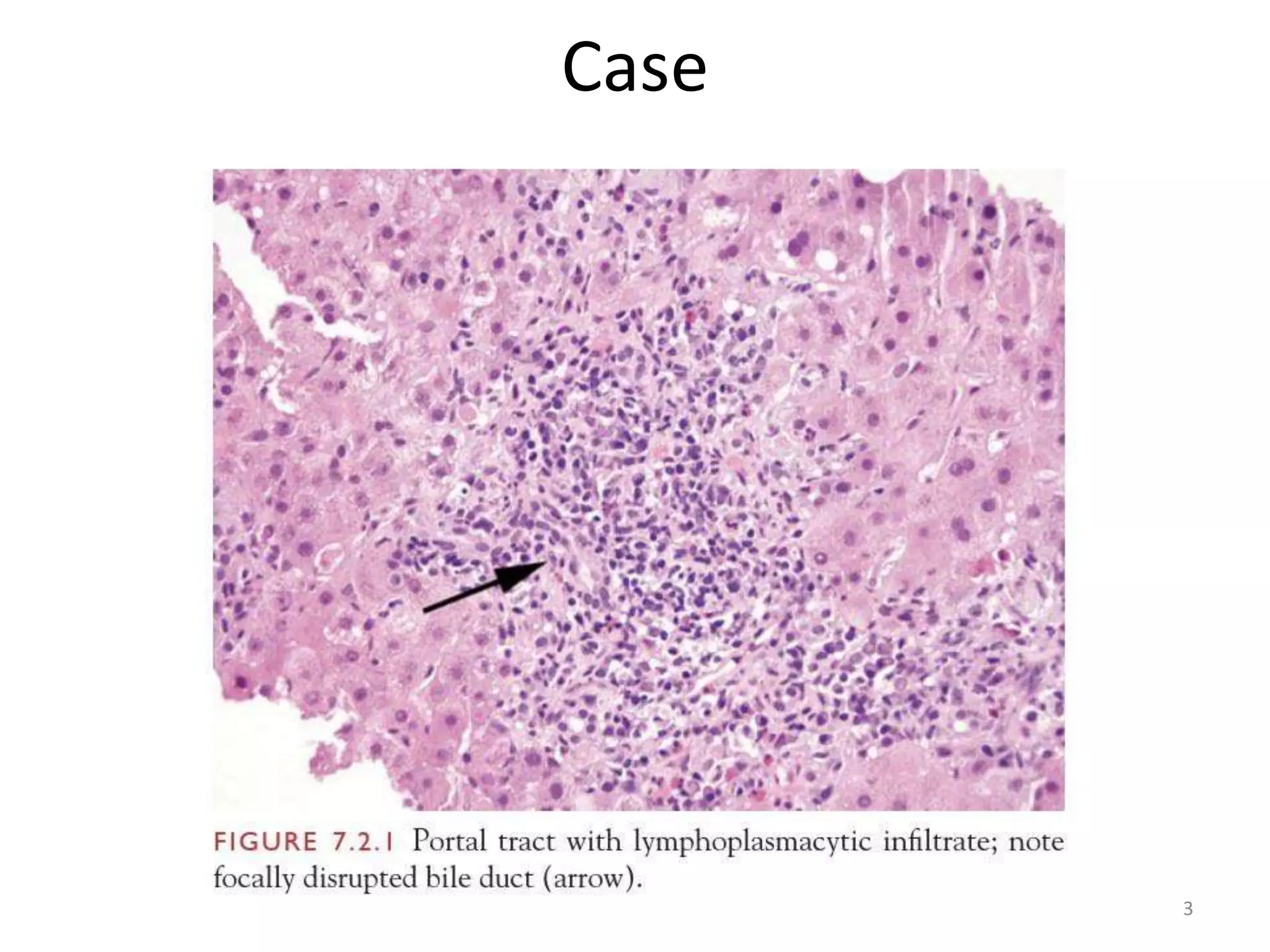 ALD, Cirrhosis, PBC and PSC | PPTX
