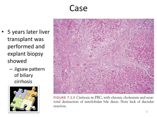 ALD, Cirrhosis, PBC and PSC | PPTX