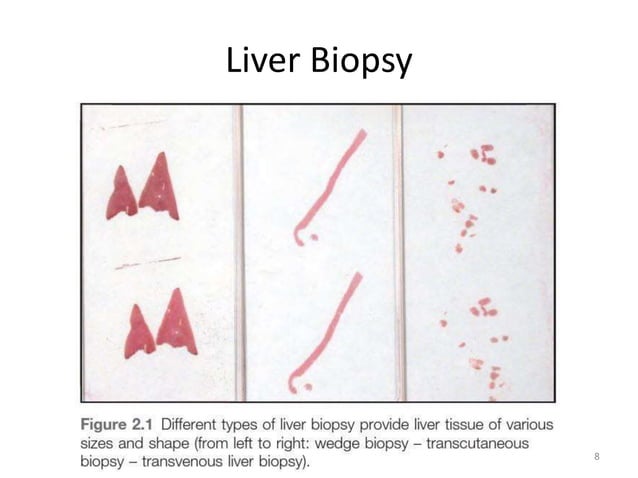 ALD, Cirrhosis, PBC and PSC | PPTX