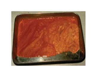 Anchovy Sauce Liver Abscess