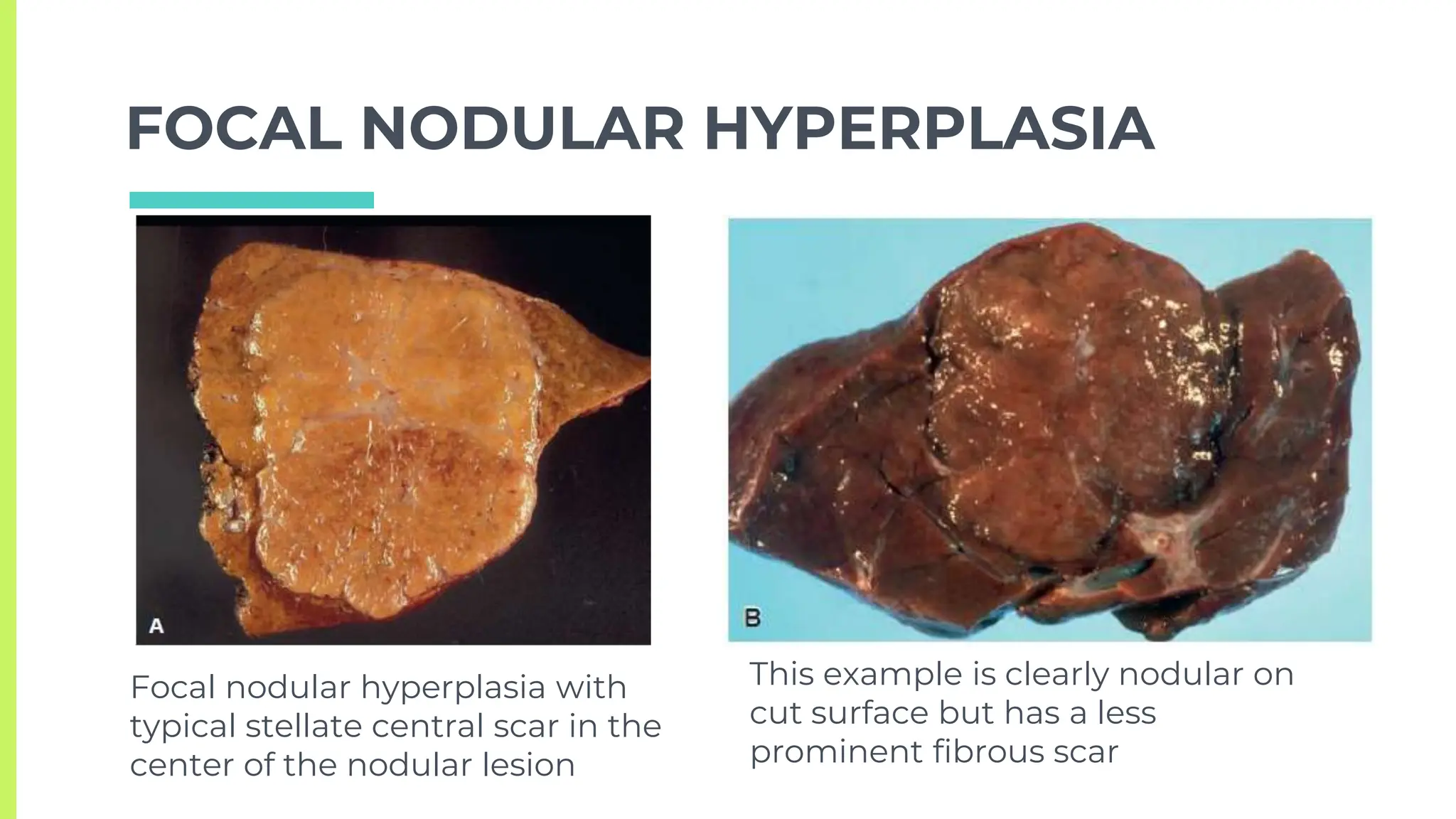 LIVER pathology. tumor and tumorlike conditions | PPTX