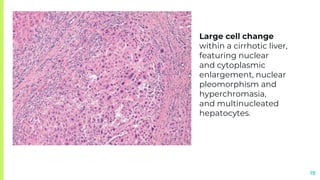 LIVER pathology. tumor and tumorlike conditions | PPTX