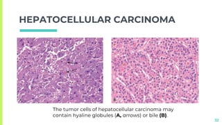 LIVER pathology. tumor and tumorlike conditions | PPTX