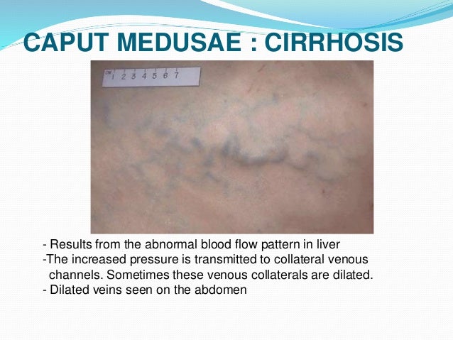 Liver surgical pathology