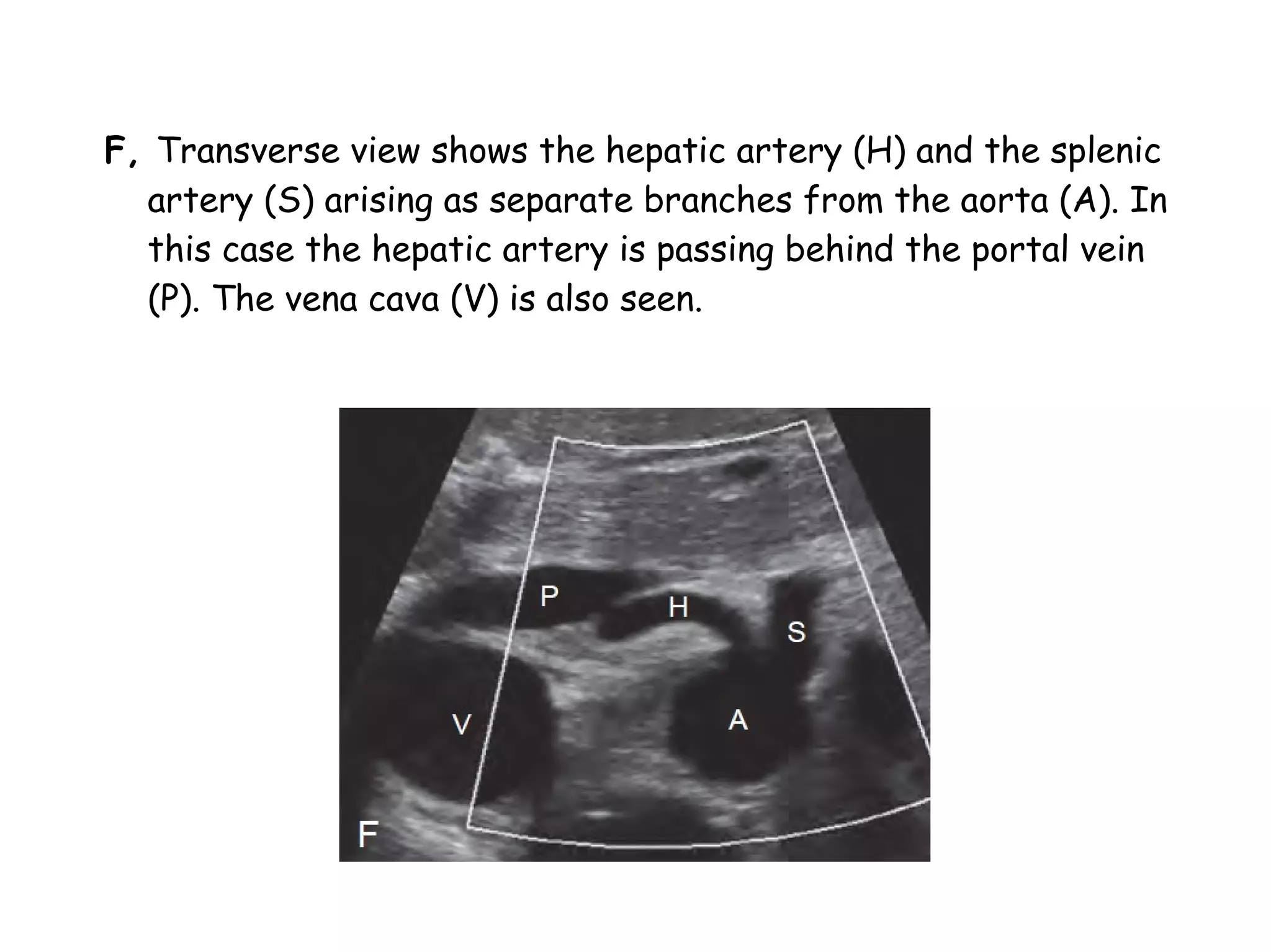 Liver Ultrasound | PPT
