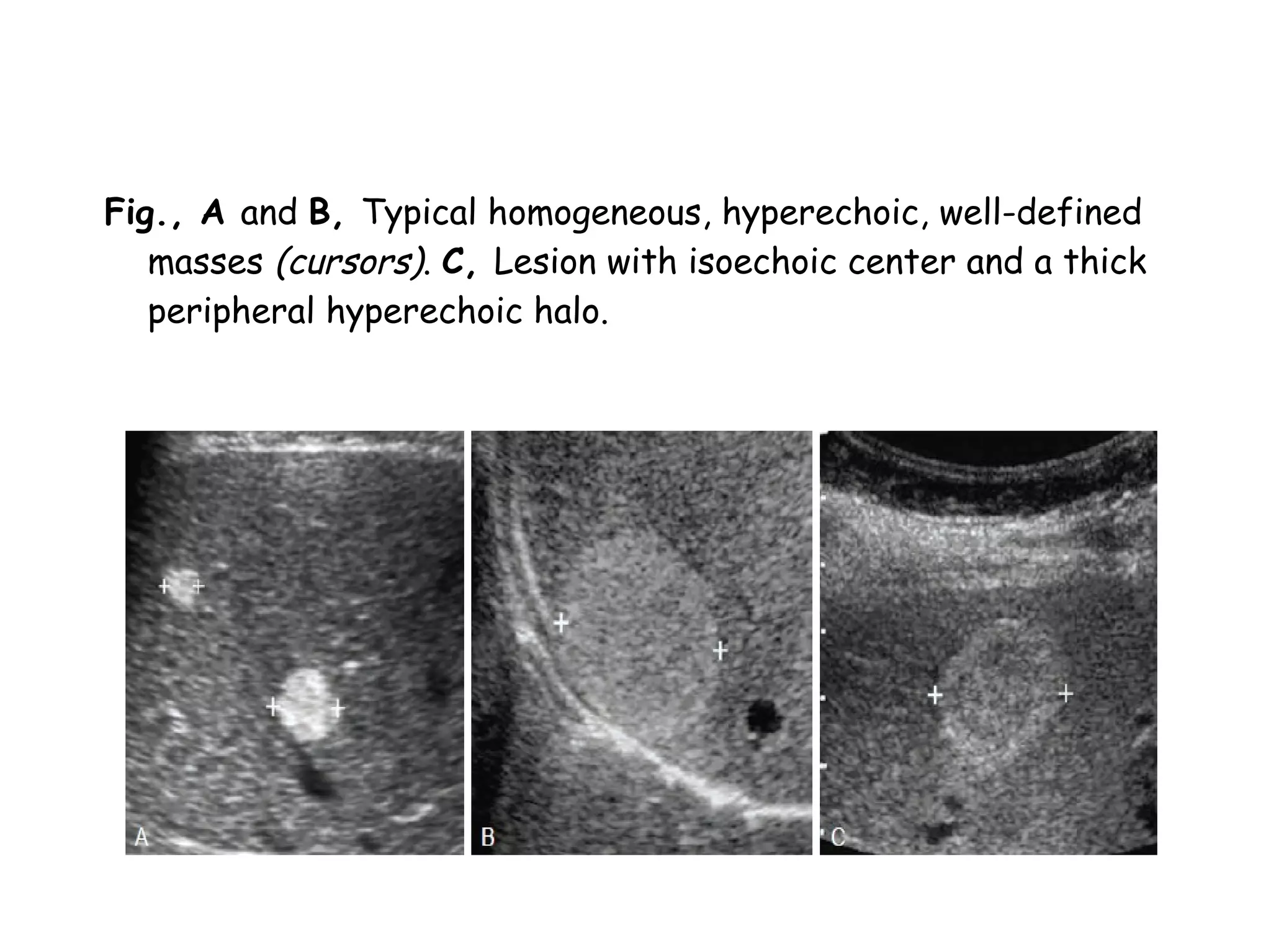 Liver Ultrasound | PPT