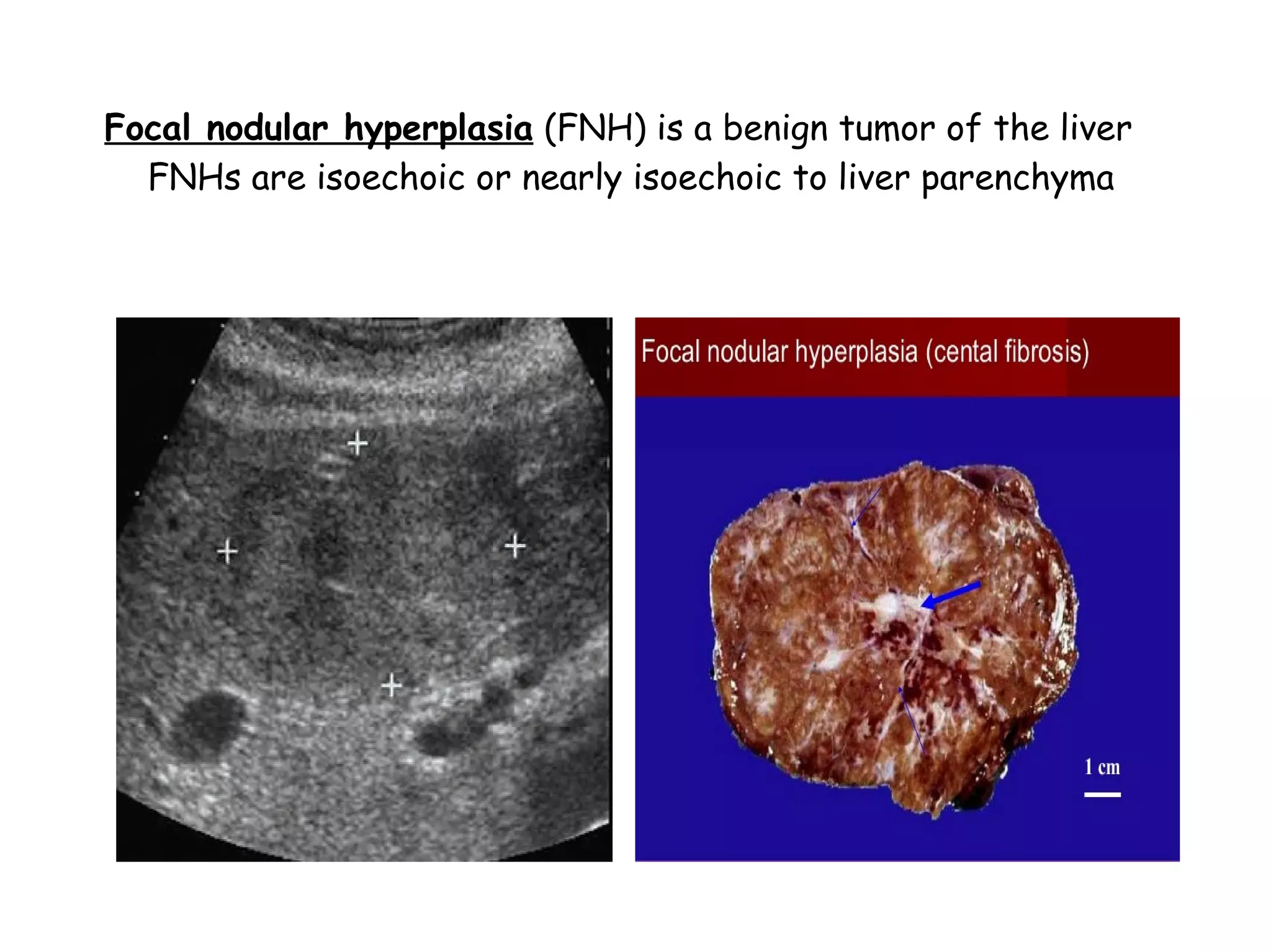 Liver Ultrasound | PPT