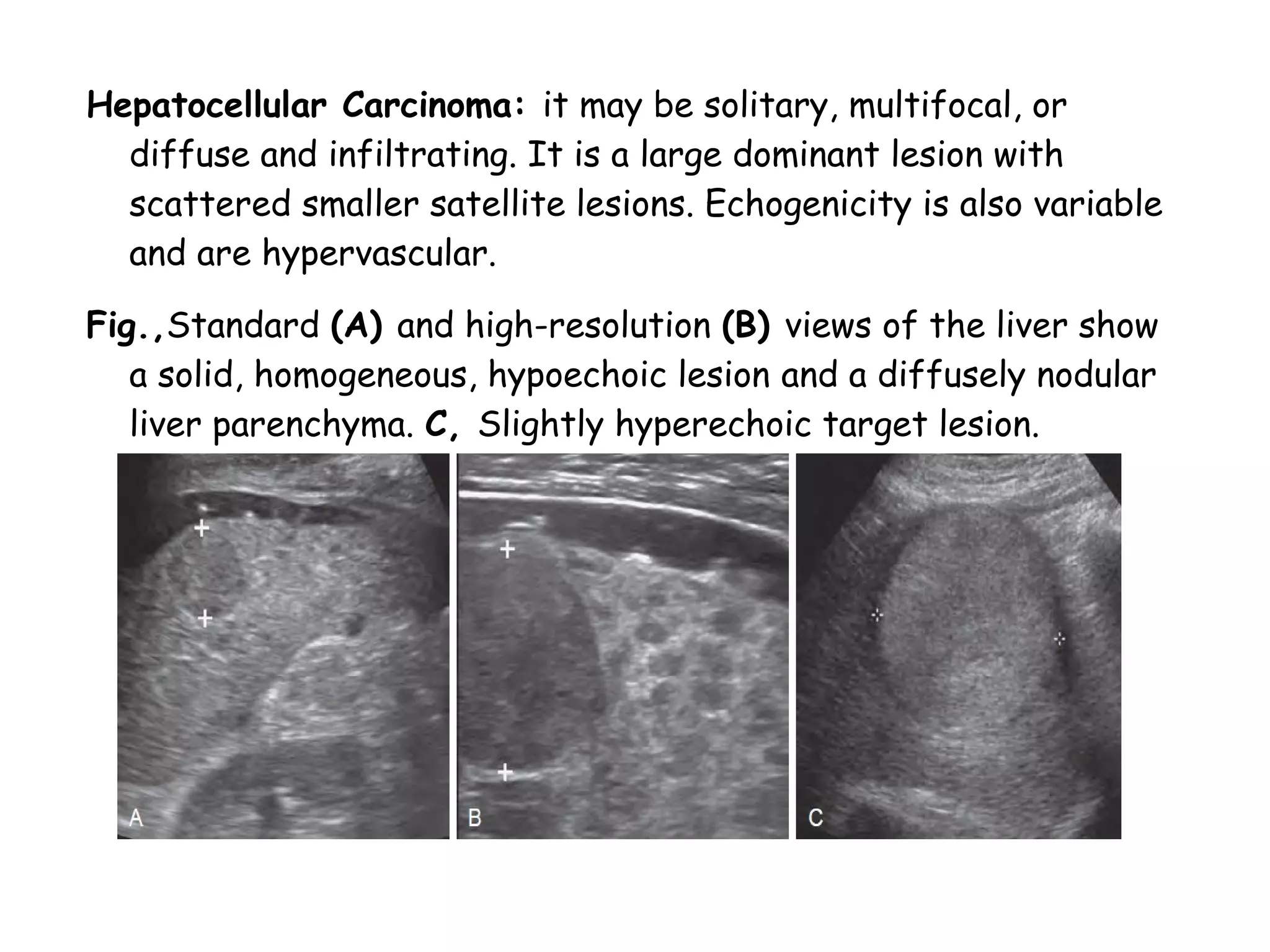Liver Ultrasound | PPT