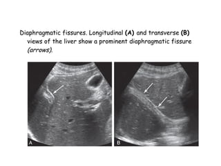 Transverse Liver Ultrasound Diaphragm
