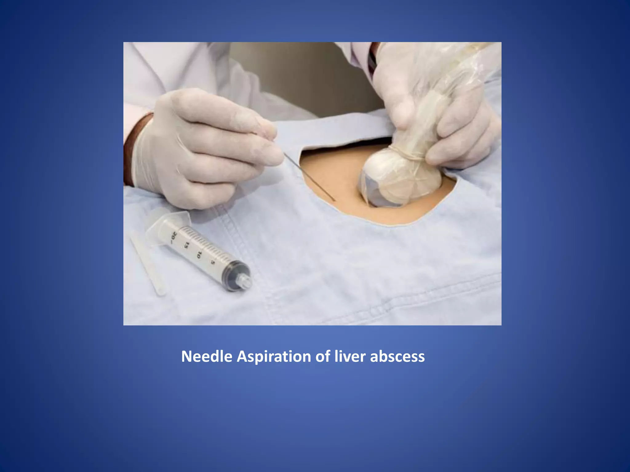 Liver abcess | PPTX