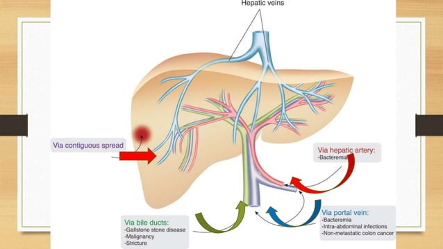 Liver abcsess | PPT