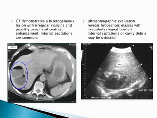 Liver Abscess | PPTX
