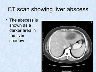 Liver abscess | PPT