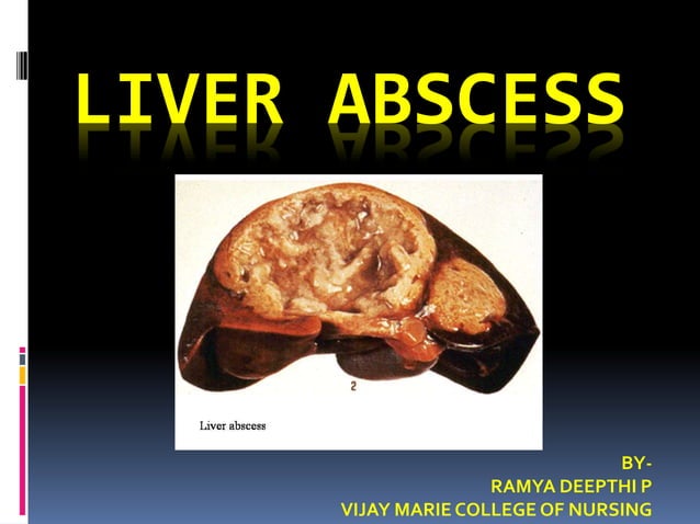 Liver abscess | PPTX | Infectious Diseases | Diseases and Conditions