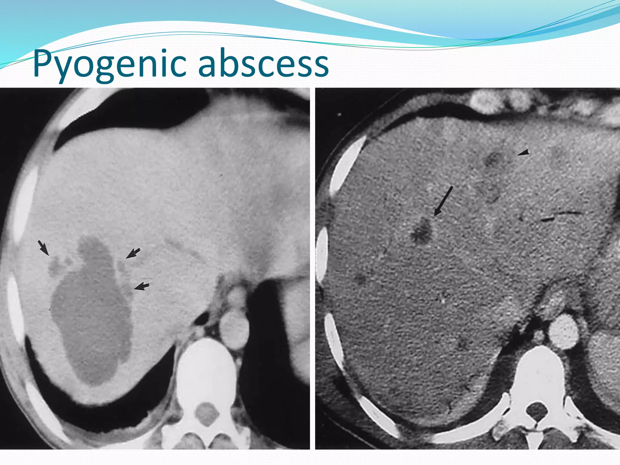 Liver abscess and comparision with different other abscess involving ...