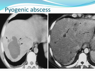 Liver abscess and comparision with different other abscess involving ...