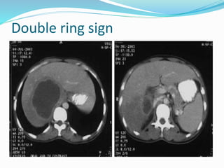 Liver abscess and comparision with different other abscess involving ...