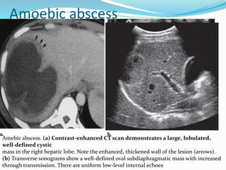 Liver abscess and comparision with different other abscess involving ...