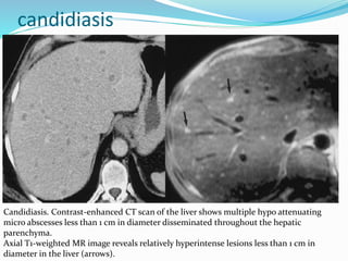 Liver abscess and comparision with different other abscess involving ...