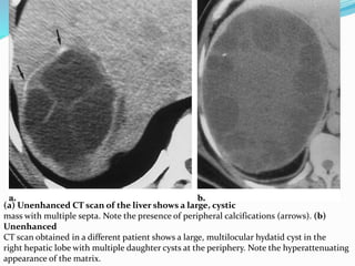 Liver abscess and comparision with different other abscess involving ...